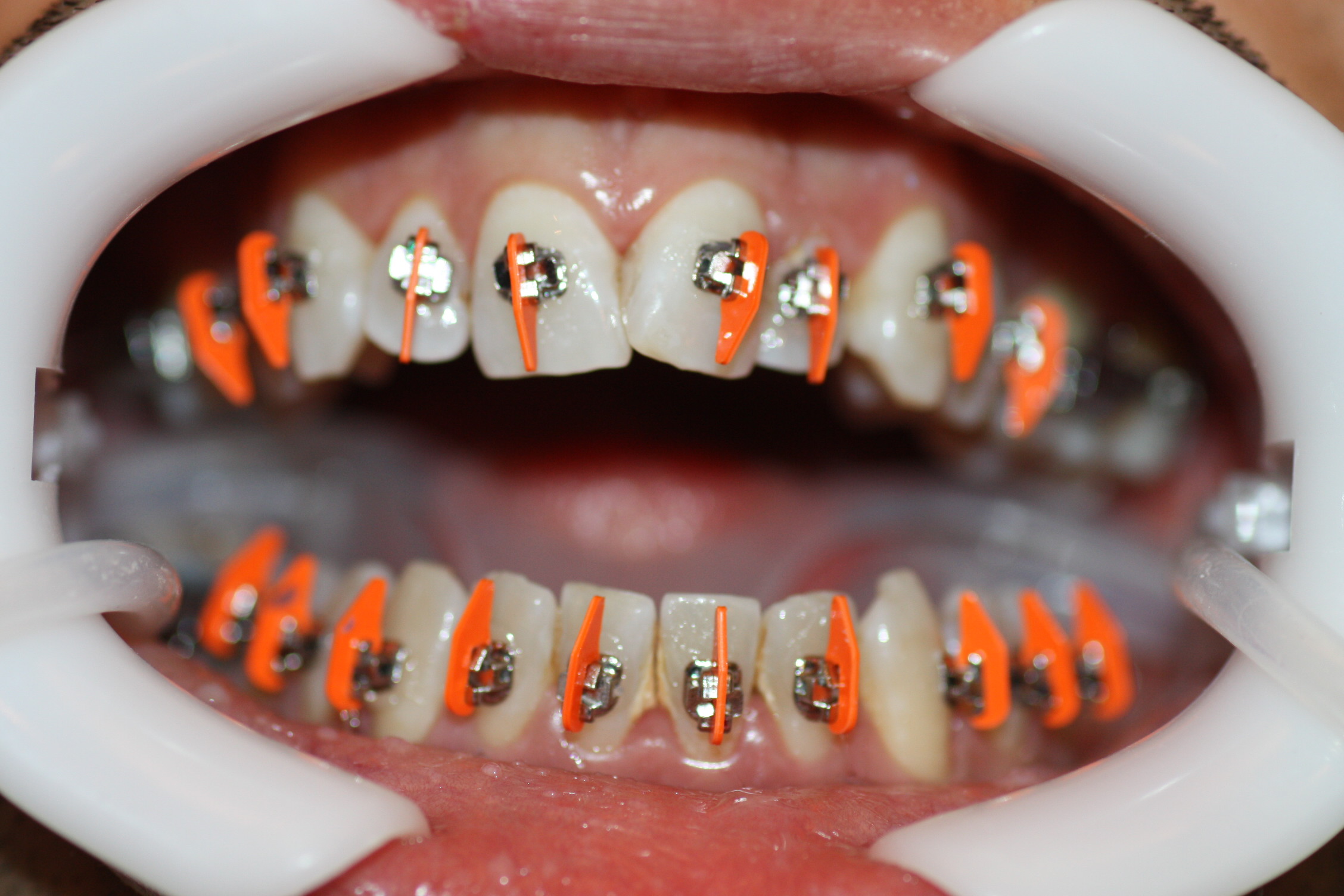 C mo Se Colocan Los Brackets De Un aparato Dental V lez Lozano