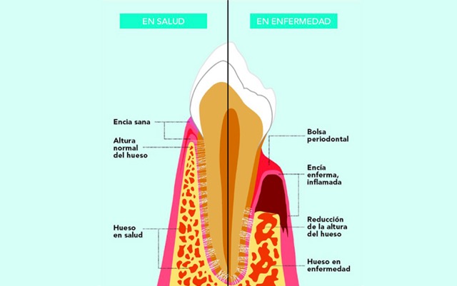 Cómo mantener sano tu periodonto - Vélez & Lozano